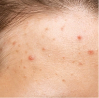 BLU-U® Blue Light Therapy – A Gentle, Effective Solution for Acne Care